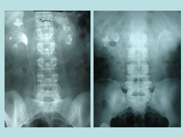6 obstructive uropathy,acute urinary retention,hematuria | PPT | Cancer ...