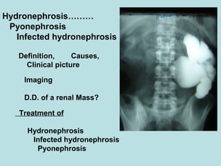 6 obstructive uropathy,acute urinary retention,hematuria | PPT | Cancer ...