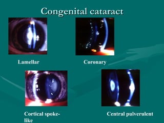 Common problems in paediatric ophthalmology | PPT