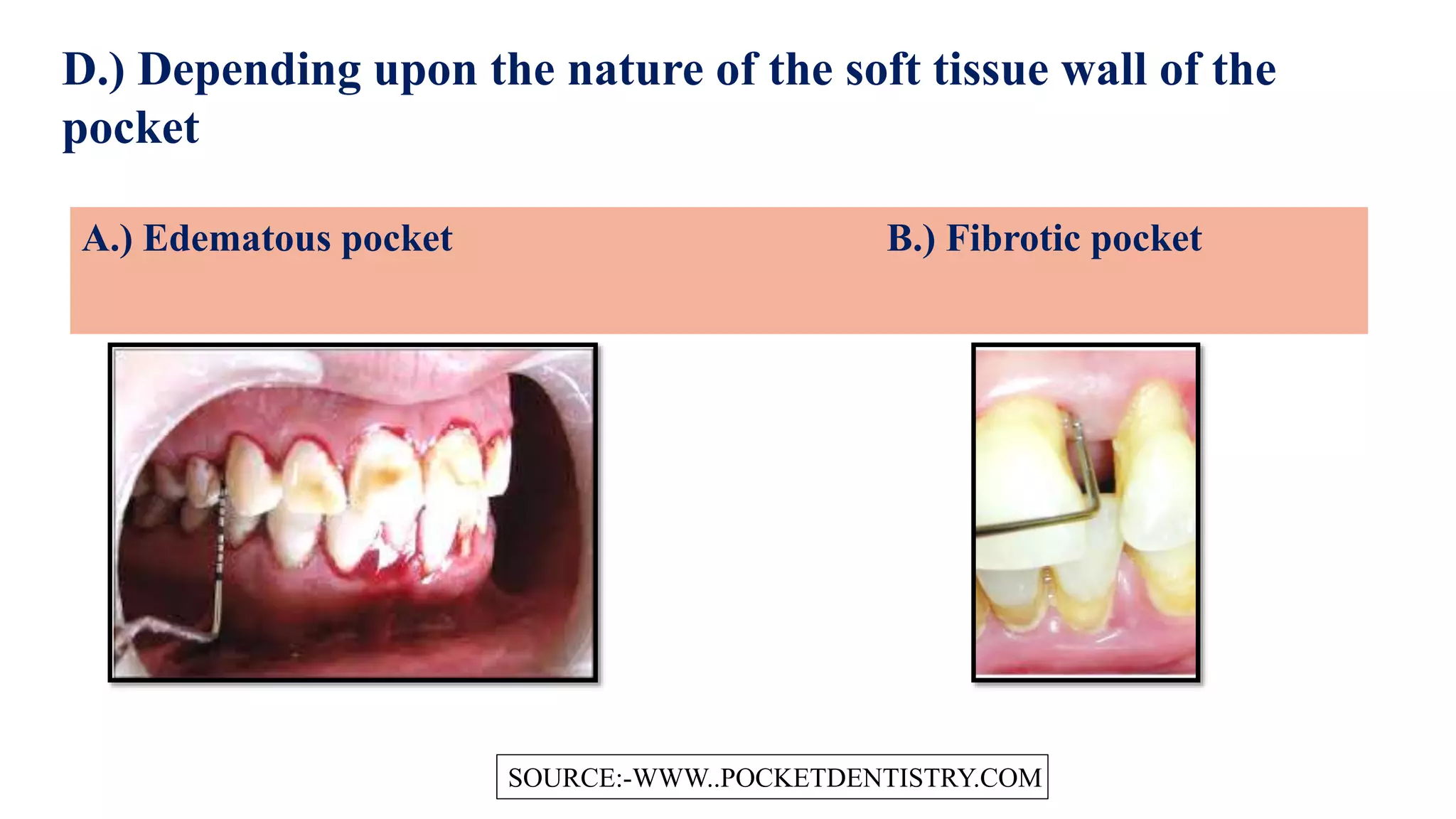 perioDONTAL pocket | PPTX