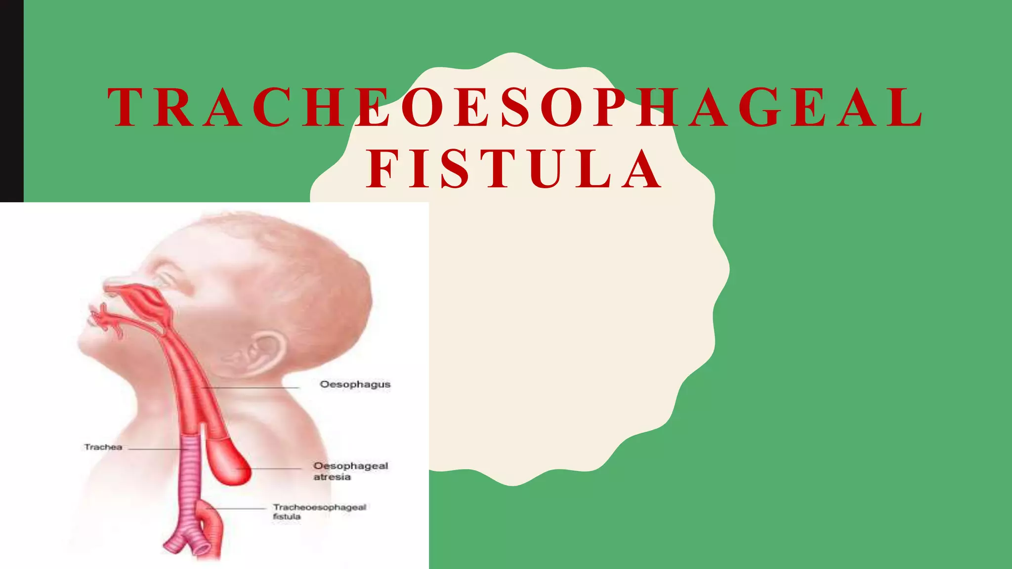 Tracheoesophageal fistula | PPTX