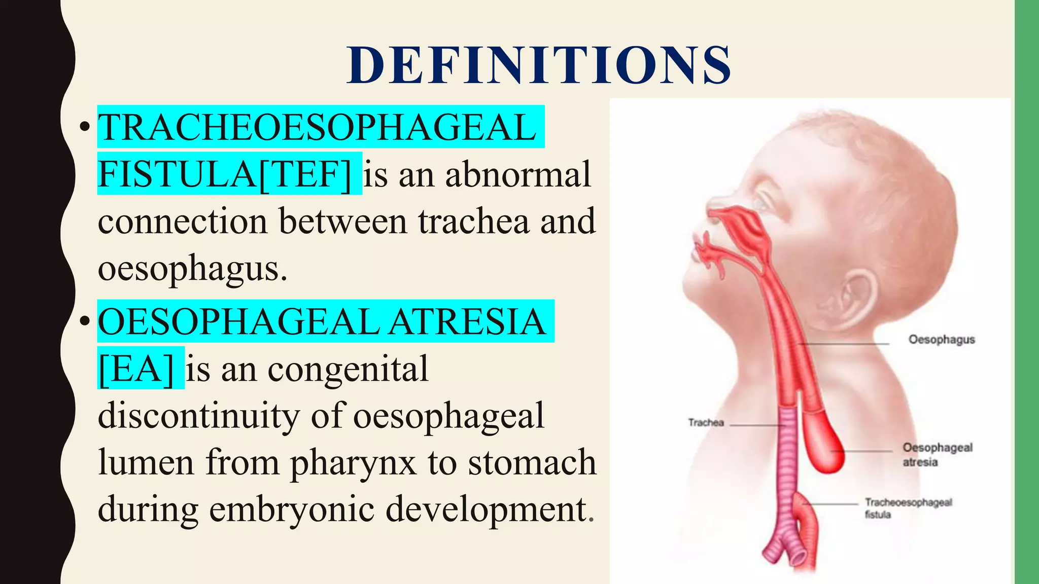 Tracheoesophageal fistula | PPTX