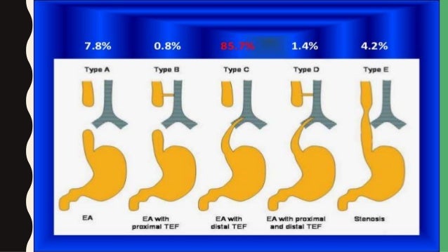 Tracheoesophageal Fistula
