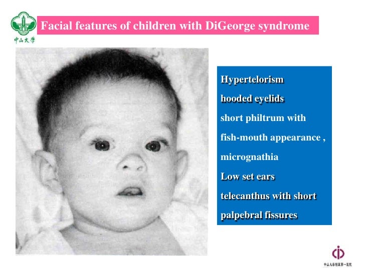 Digeorge Syndrome Life Expectancy Charts