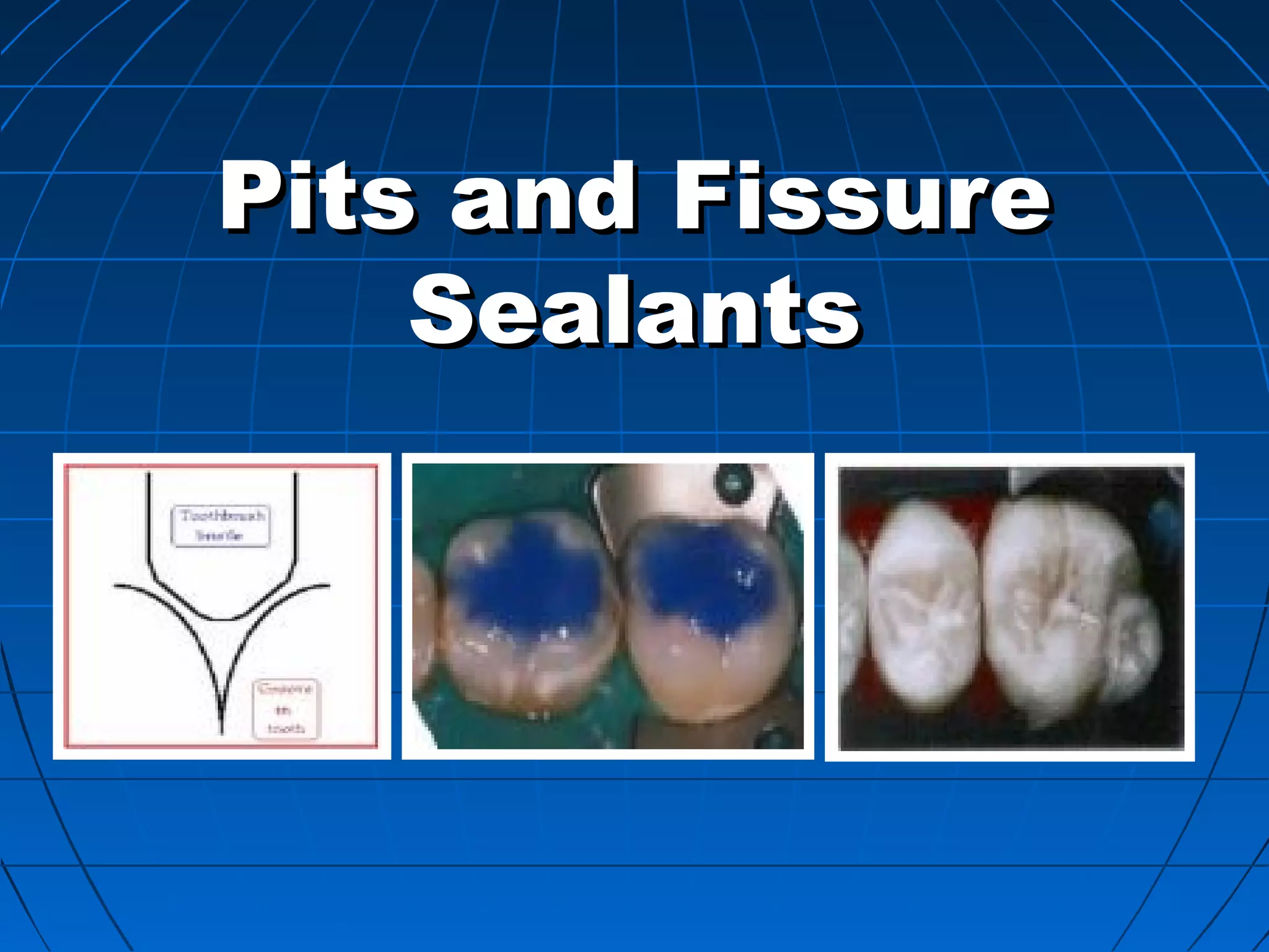 pits and fissure sealants dental material | PPS