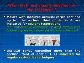 pits and fissure sealants dental material | PPS