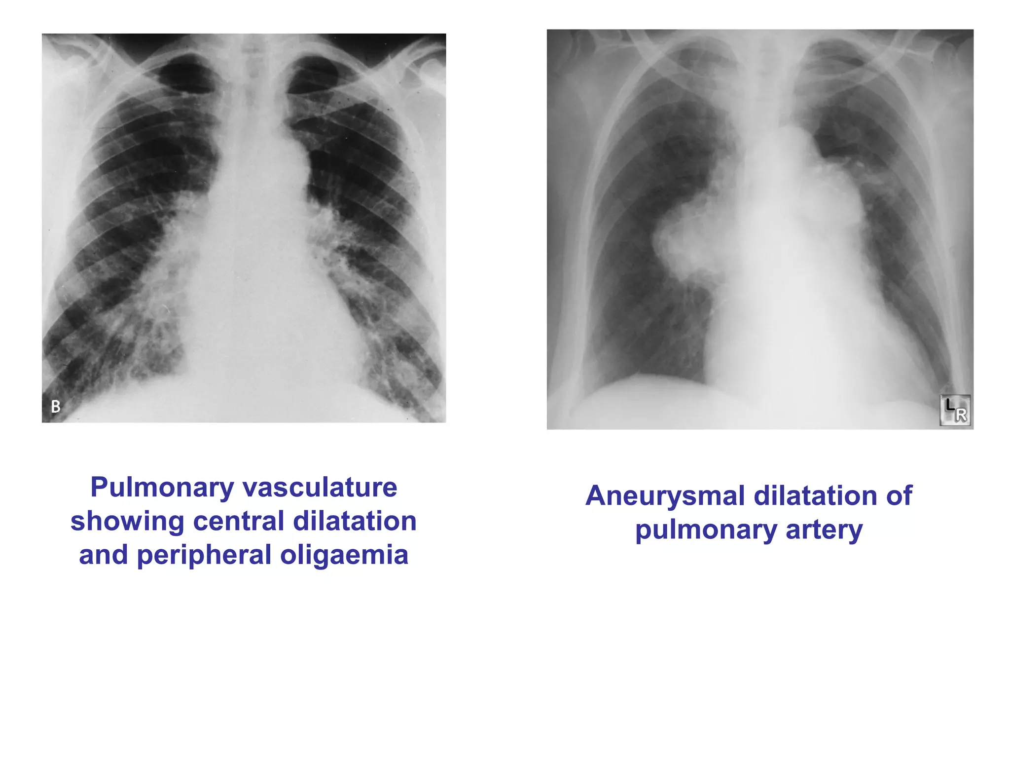 6 pulmonary hypertension | PPT