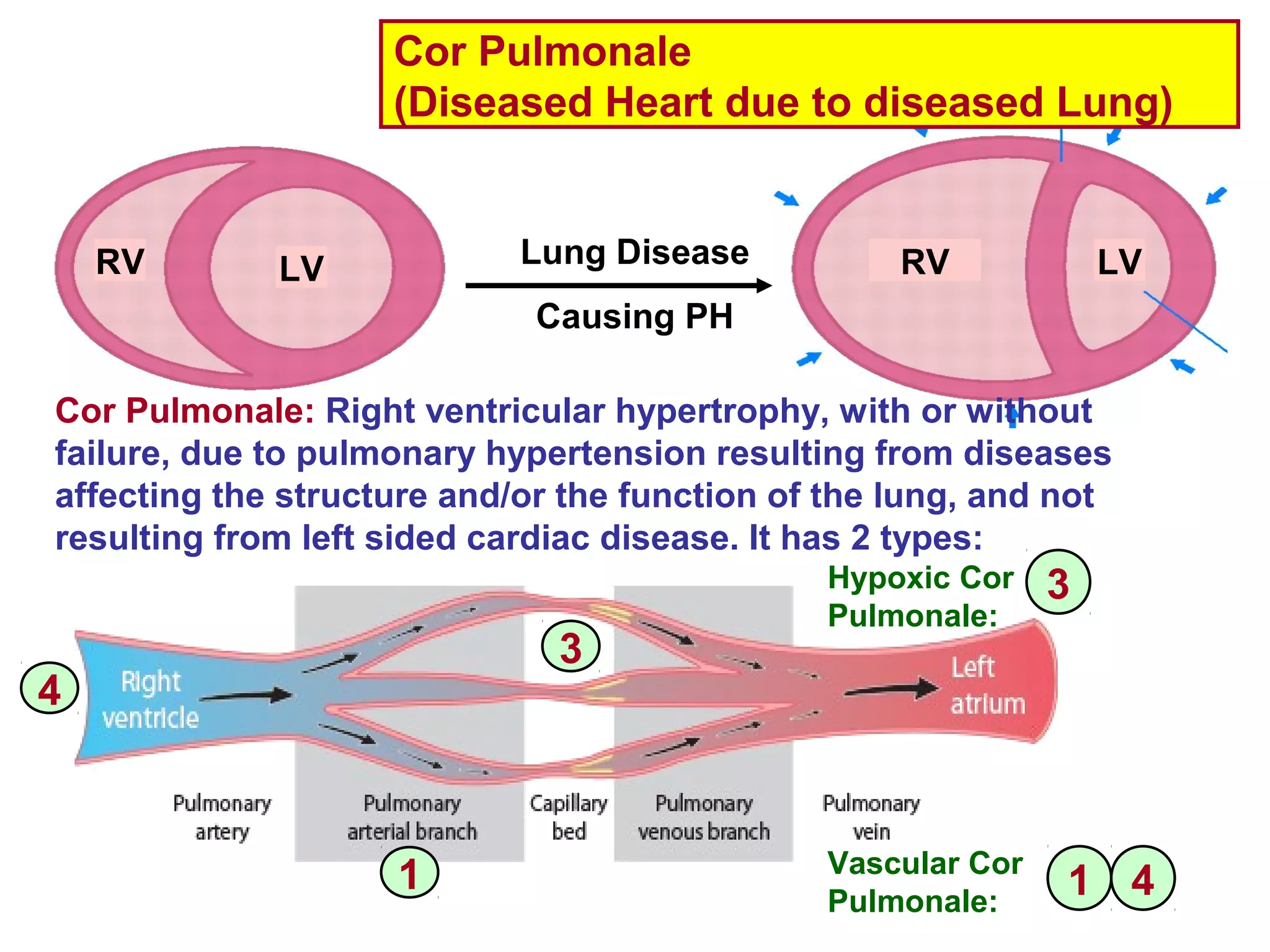 6 pulmonary hypertension | PPT