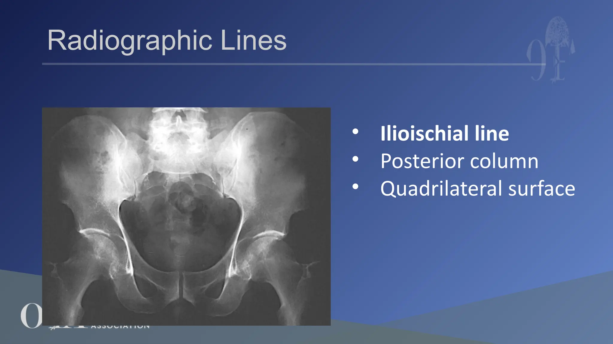 6_Radiographic Understanding, Evaluation & Classification of Acetabular ...