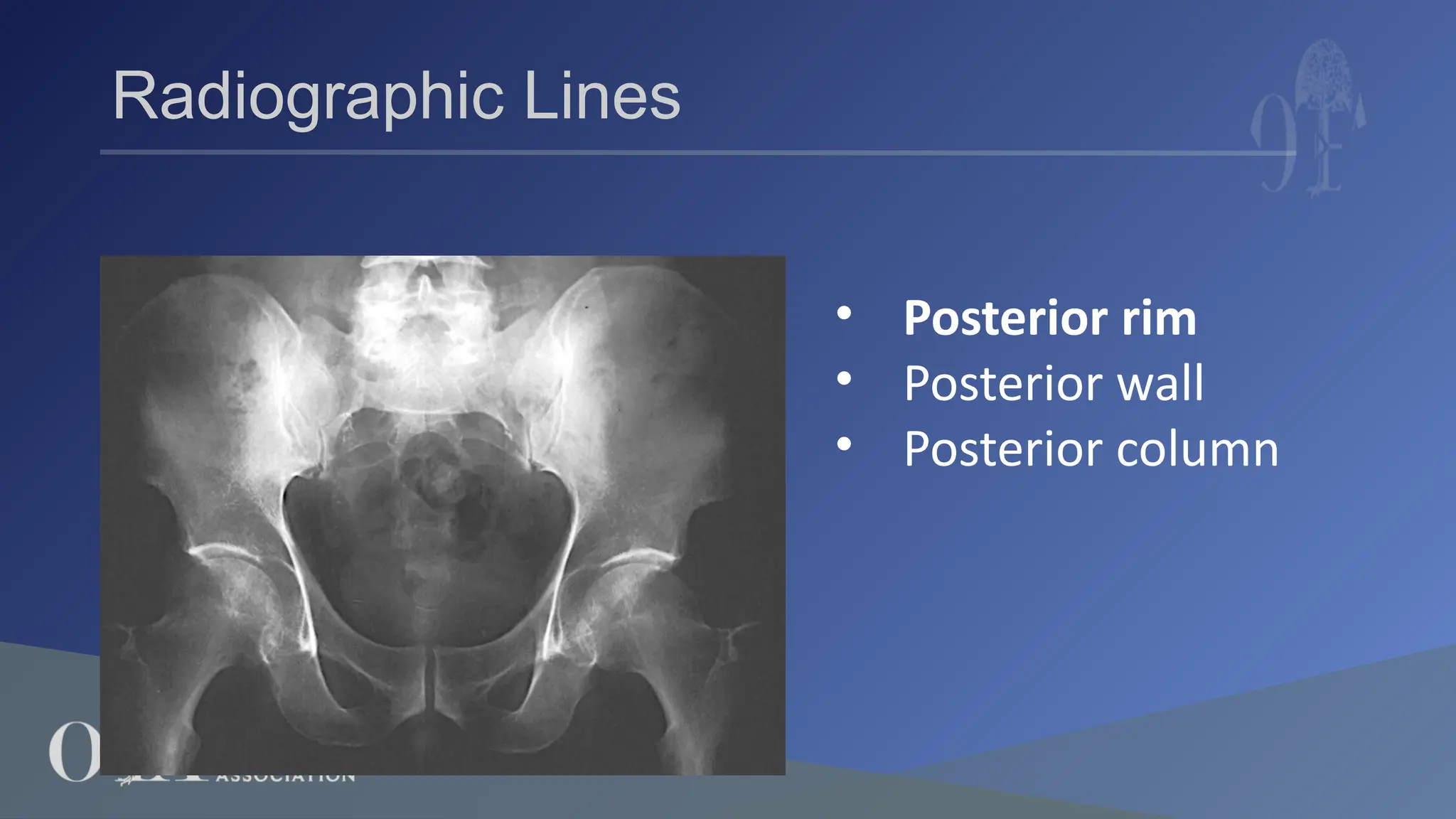 6_Radiographic Understanding, Evaluation & Classification of Acetabular ...
