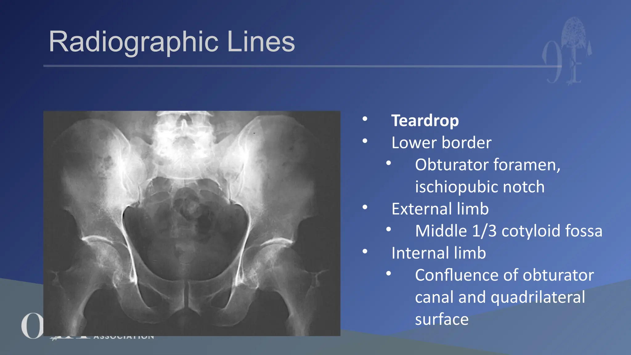 6_Radiographic Understanding, Evaluation & Classification of Acetabular ...