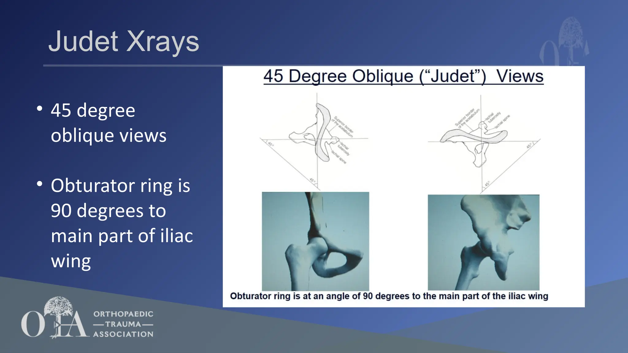 6_Radiographic Understanding, Evaluation & Classification of Acetabular ...