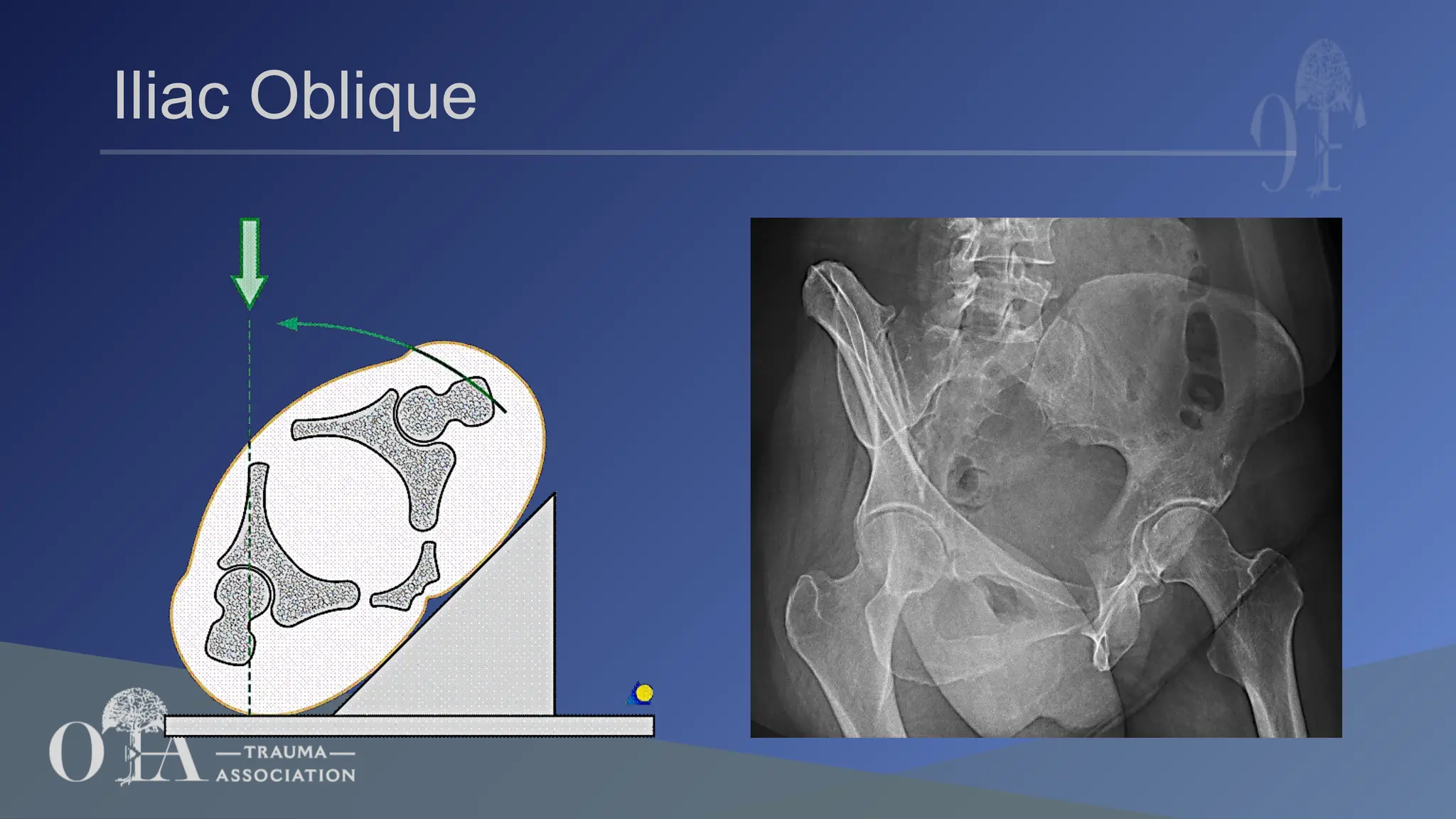 6_Radiographic Understanding, Evaluation & Classification of Acetabular ...