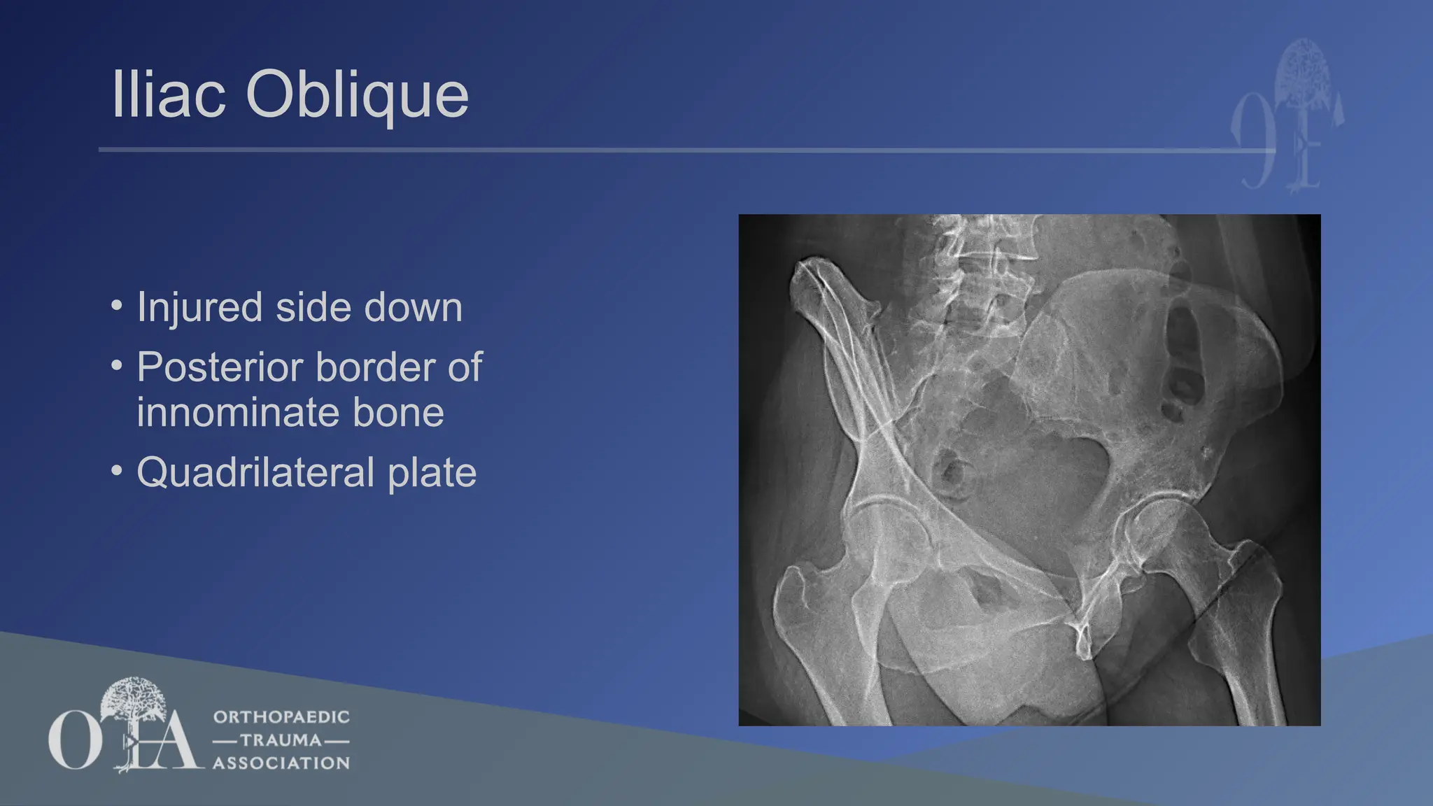 6_Radiographic Understanding, Evaluation & Classification of Acetabular ...