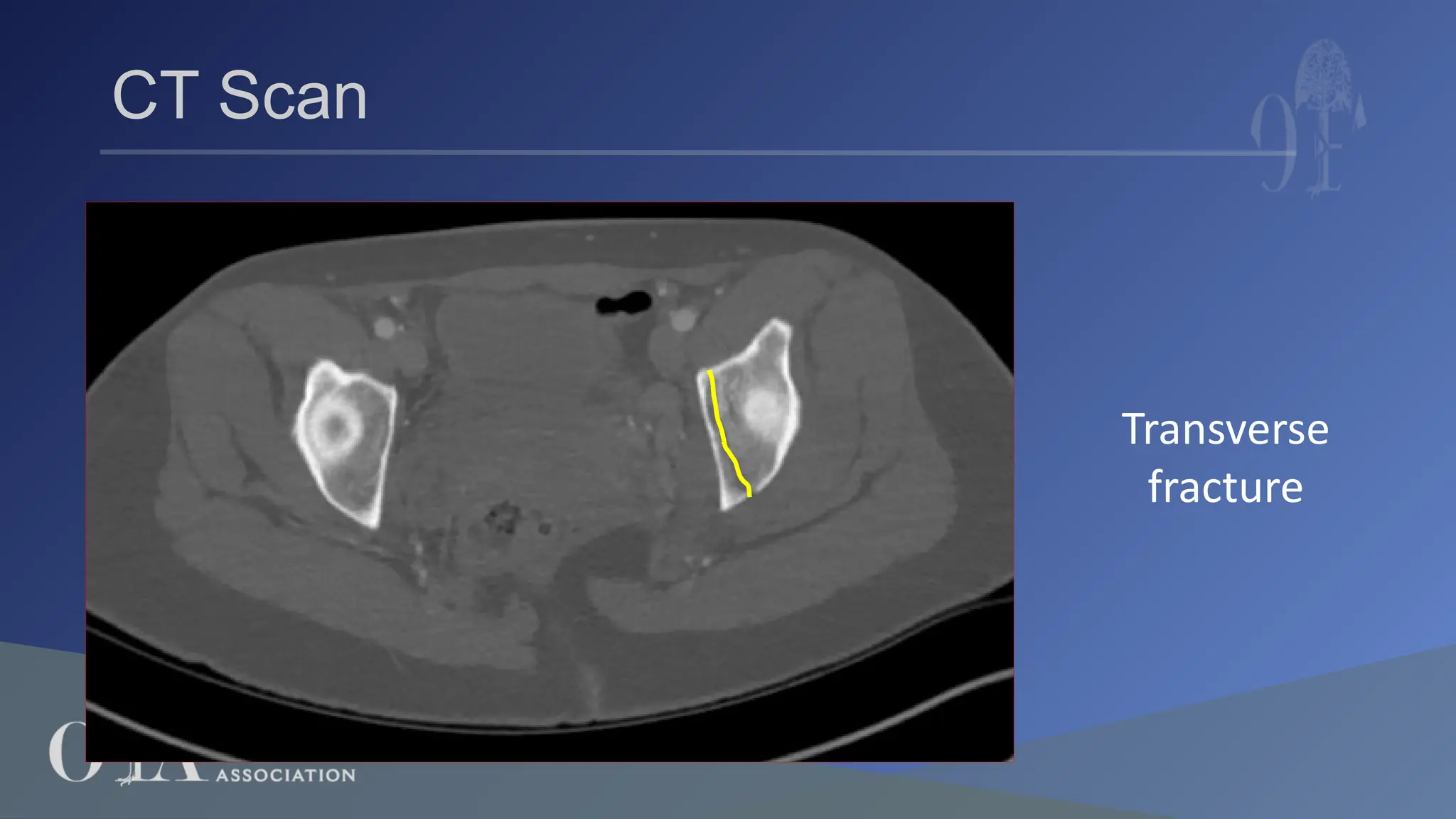 6_Radiographic Understanding, Evaluation & Classification of Acetabular ...