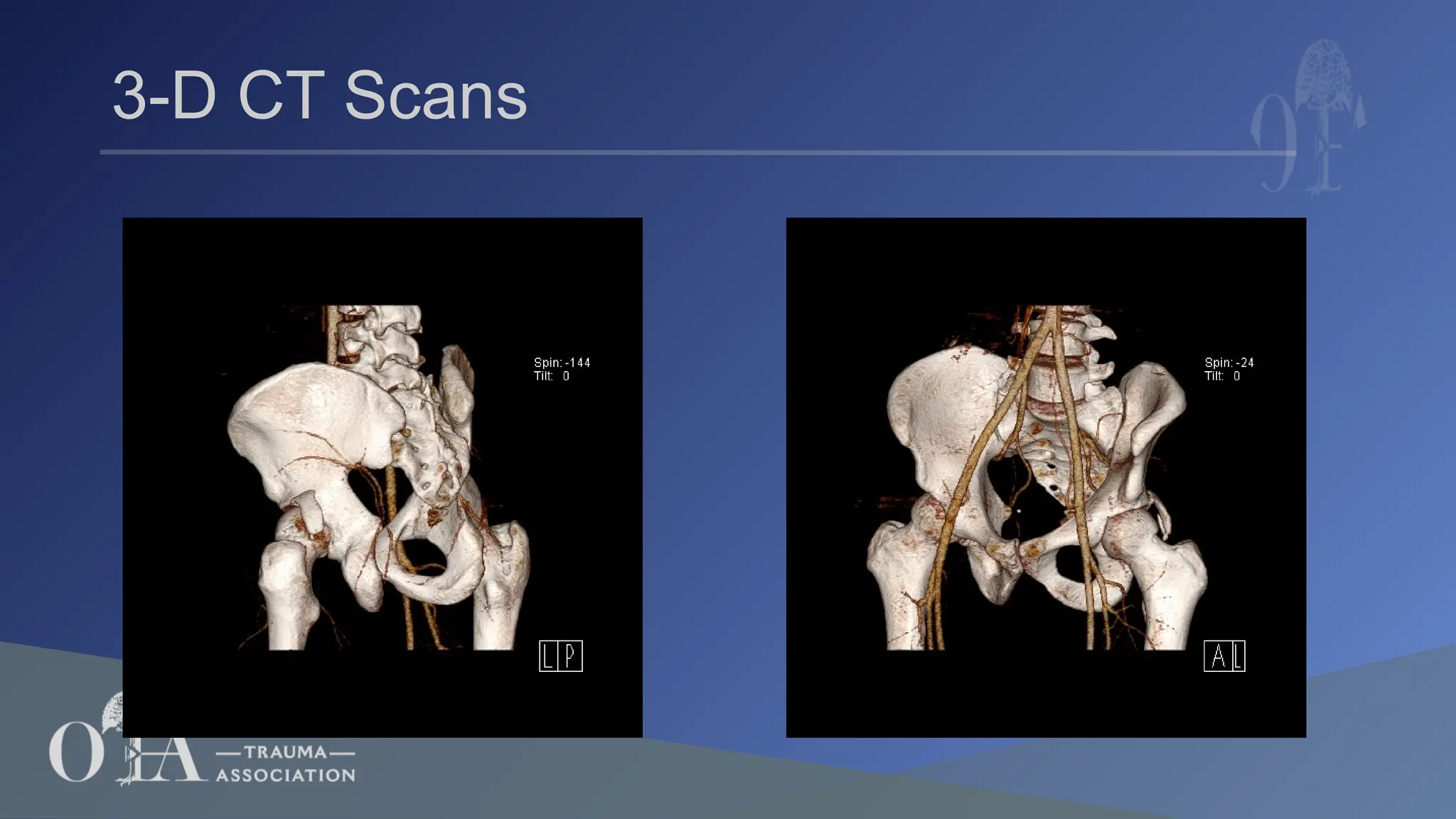6_Radiographic Understanding, Evaluation & Classification of Acetabular ...