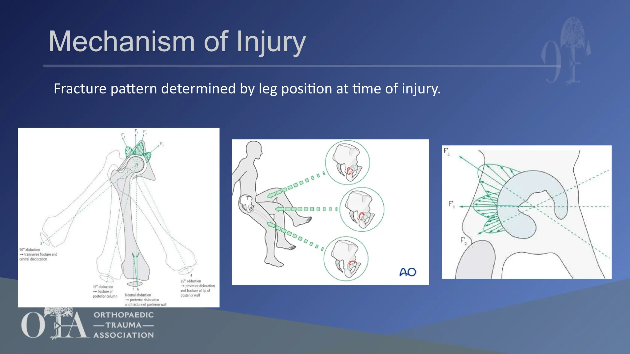 6_Radiographic Understanding, Evaluation & Classification of Acetabular ...
