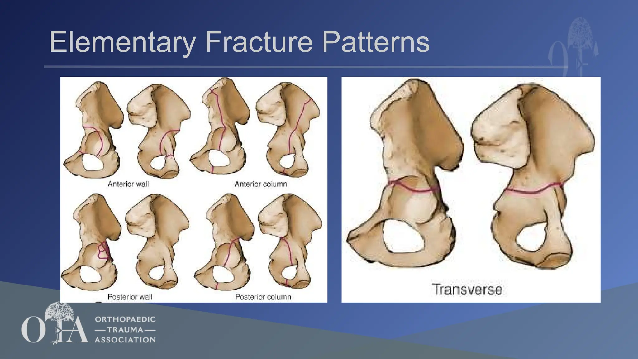 6_Radiographic Understanding, Evaluation & Classification of Acetabular ...