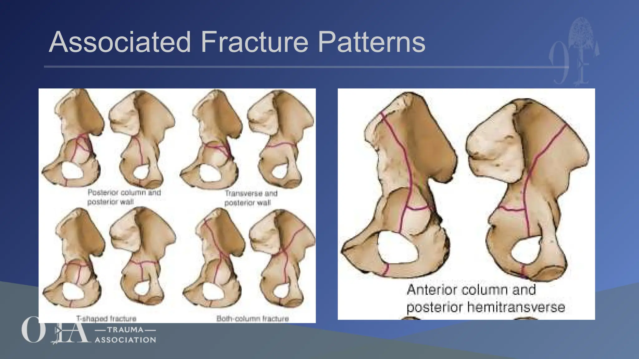 6_Radiographic Understanding, Evaluation & Classification of Acetabular ...