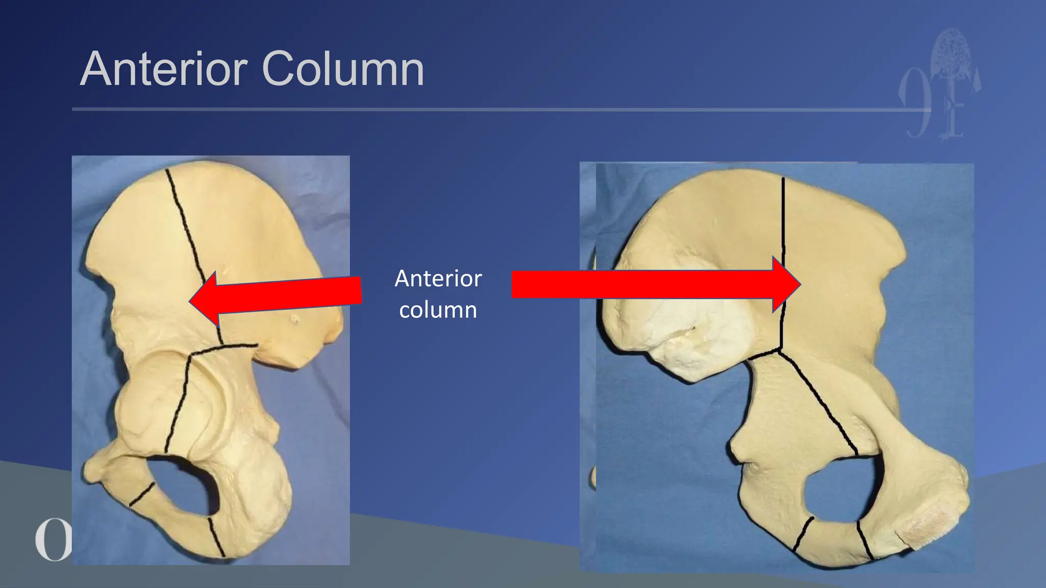 6_Radiographic Understanding, Evaluation & Classification of Acetabular ...