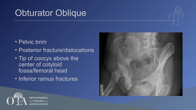 6_Radiographic Understanding, Evaluation & Classification of Acetabular ...
