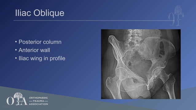 6_Radiographic Understanding, Evaluation & Classification of Acetabular ...