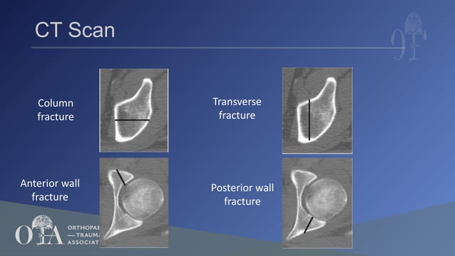 6_Radiographic Understanding, Evaluation & Classification of Acetabular ...