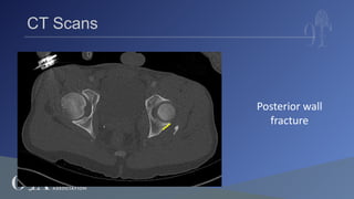 6_Radiographic Understanding, Evaluation & Classification of Acetabular ...