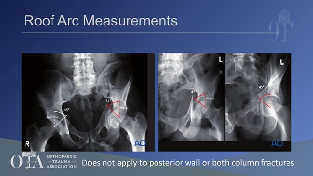6_Radiographic Understanding, Evaluation & Classification of Acetabular ...