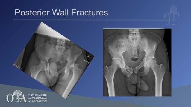 6_Radiographic Understanding, Evaluation & Classification of Acetabular ...
