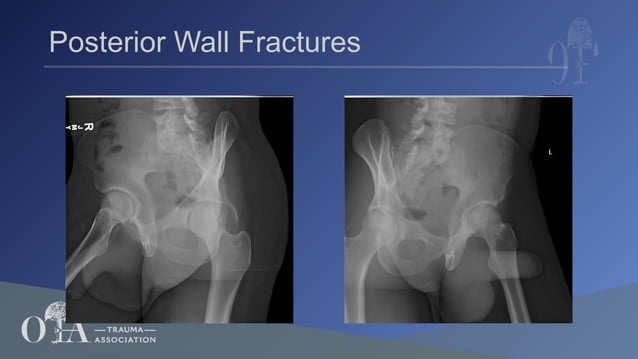 6_Radiographic Understanding, Evaluation & Classification of Acetabular ...