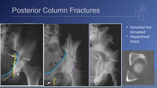 6_Radiographic Understanding, Evaluation & Classification of Acetabular ...