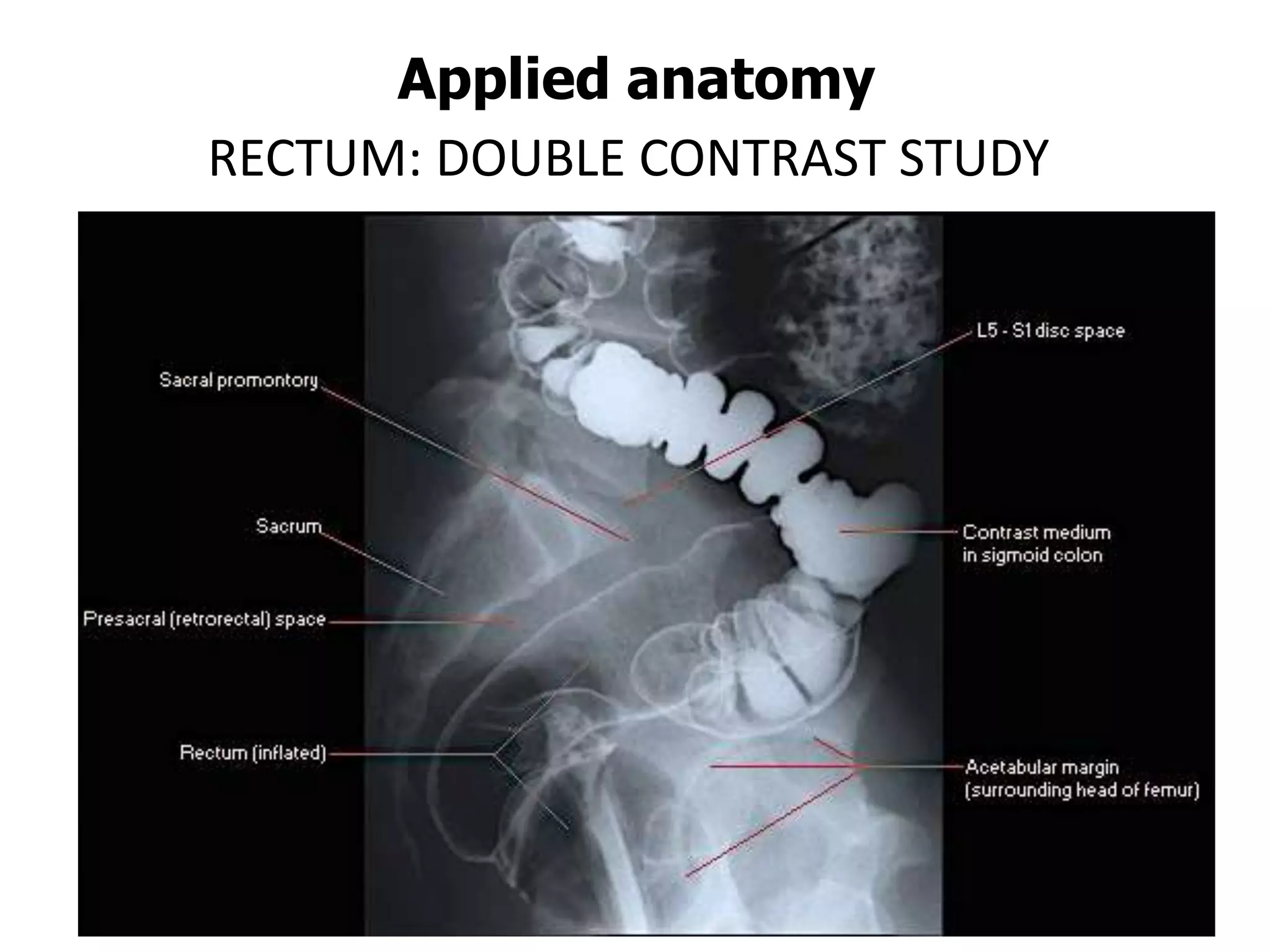 Anatomy of Rectum | PPTX