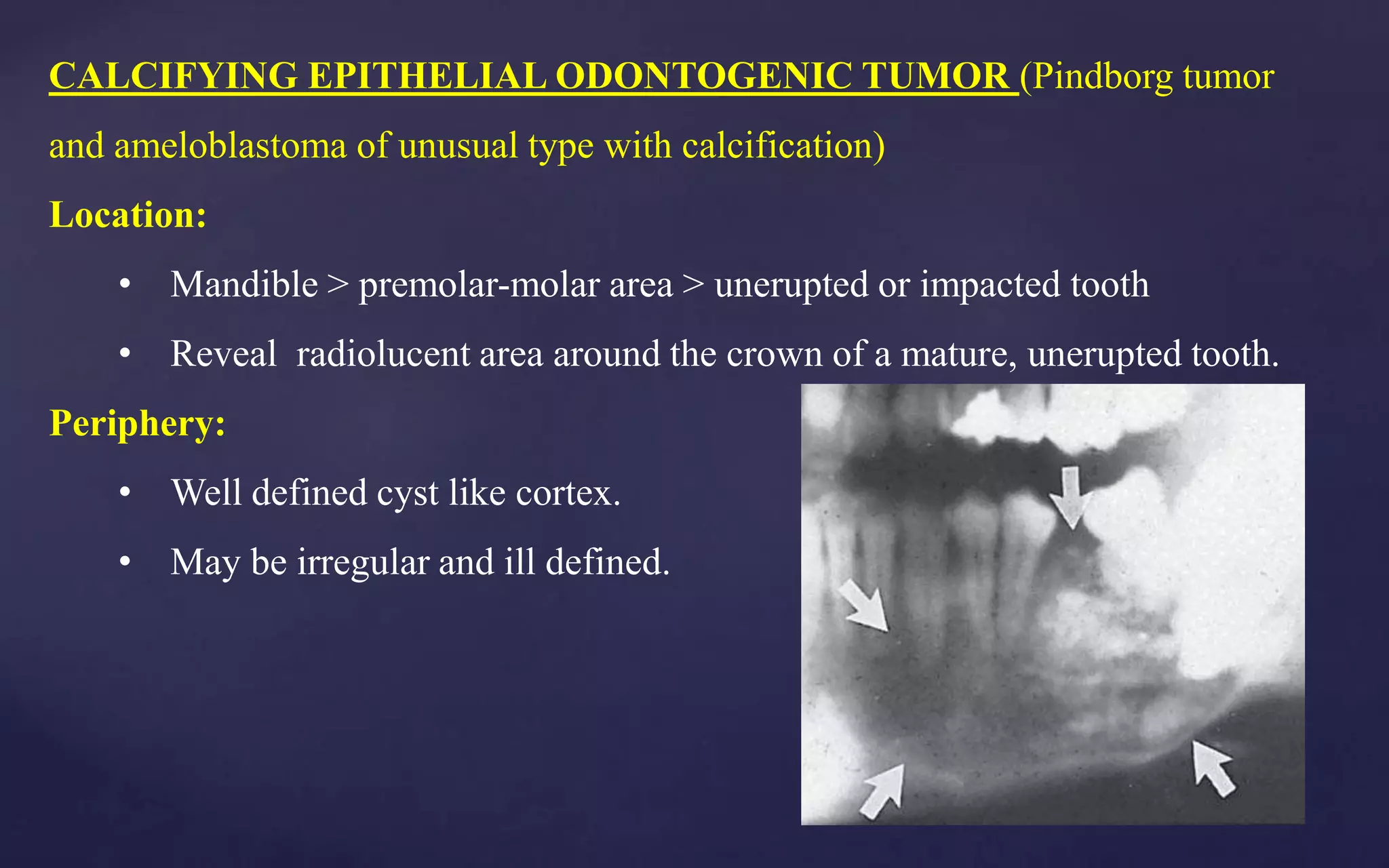 RADIOGRAPHIC FEATURES OF TUMORS OF JAWS | PPTX