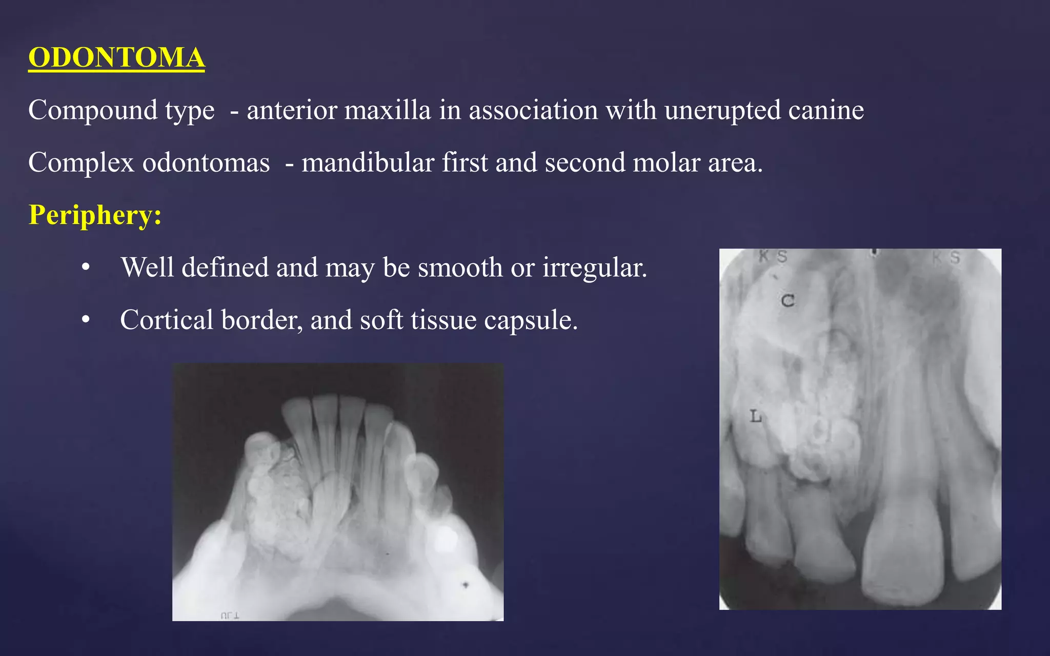 RADIOGRAPHIC FEATURES OF TUMORS OF JAWS | PPTX