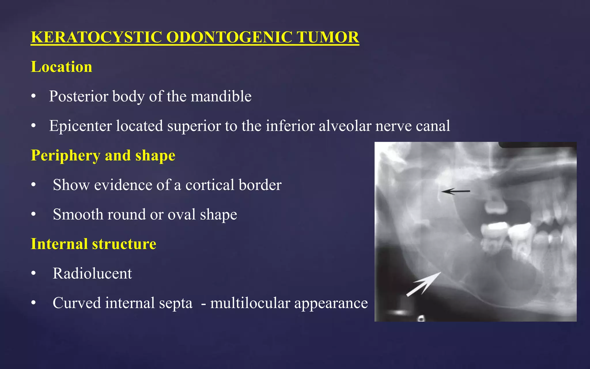 RADIOGRAPHIC FEATURES OF TUMORS OF JAWS | PPTX