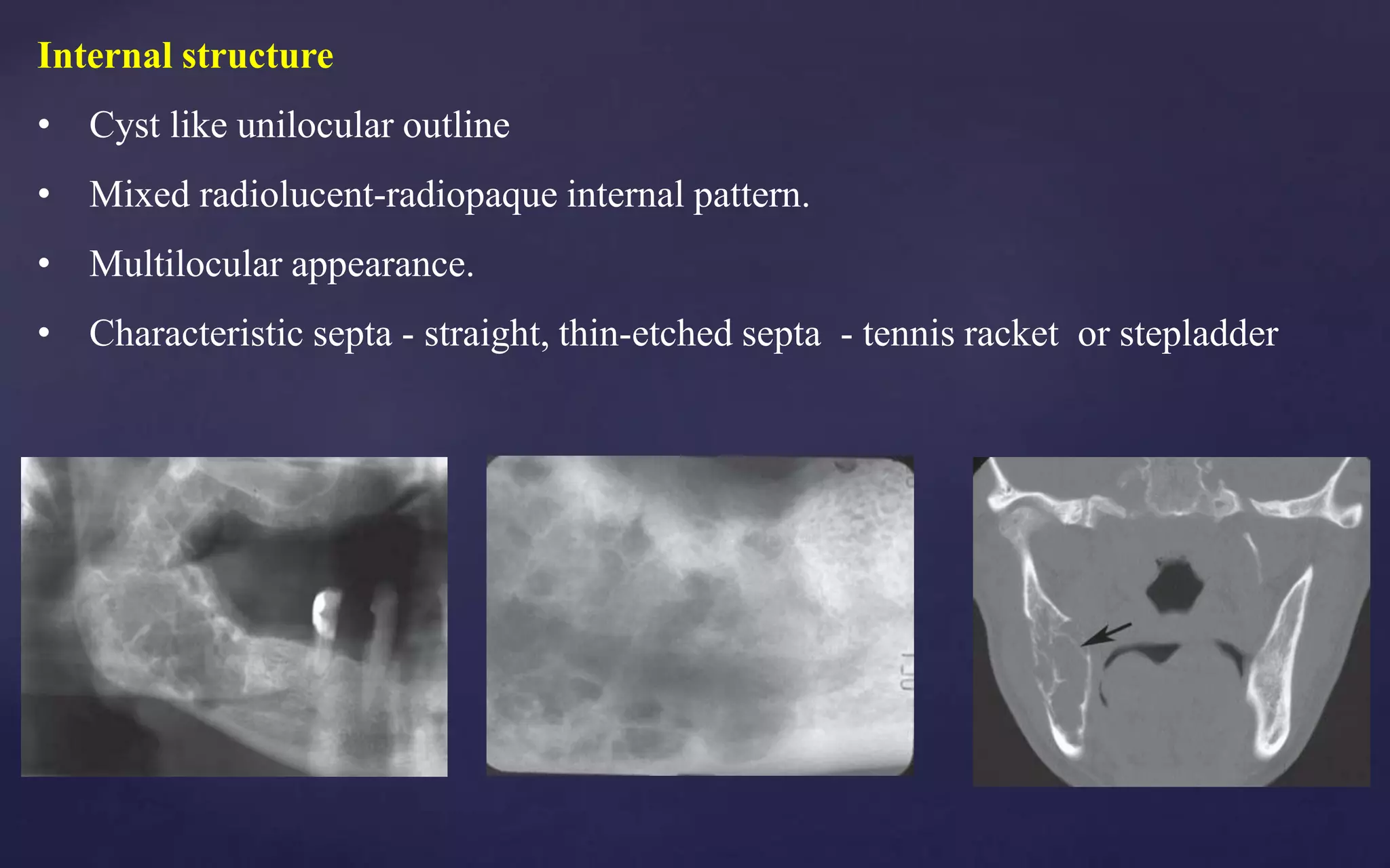 RADIOGRAPHIC FEATURES OF TUMORS OF JAWS | PPTX