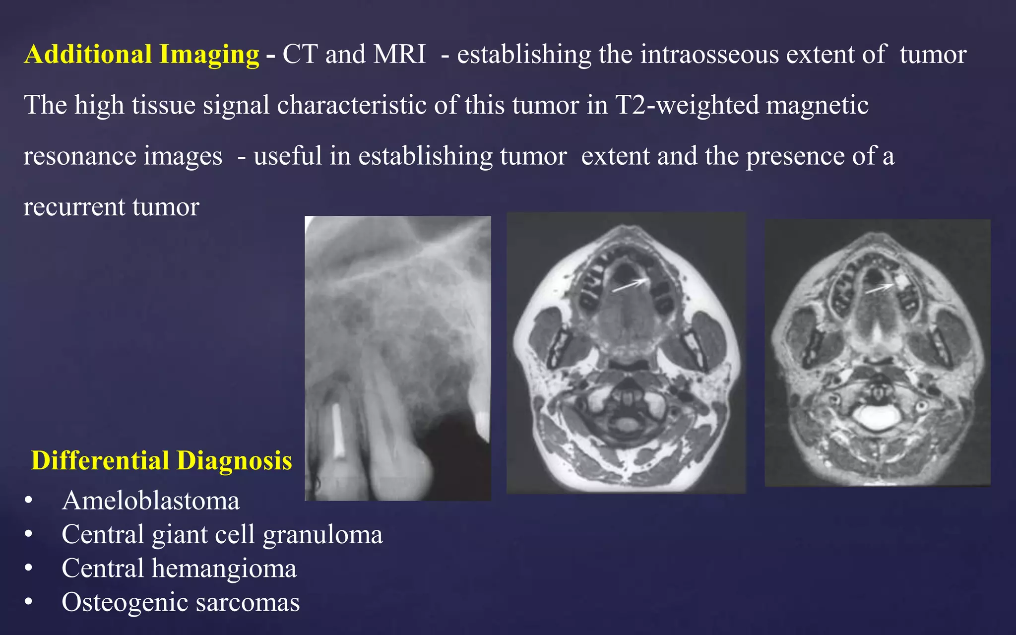 RADIOGRAPHIC FEATURES OF TUMORS OF JAWS | PPTX
