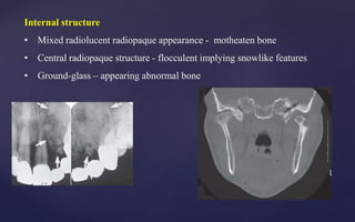 RADIOGRAPHIC FEATURES OF TUMORS OF JAWS | PPTX