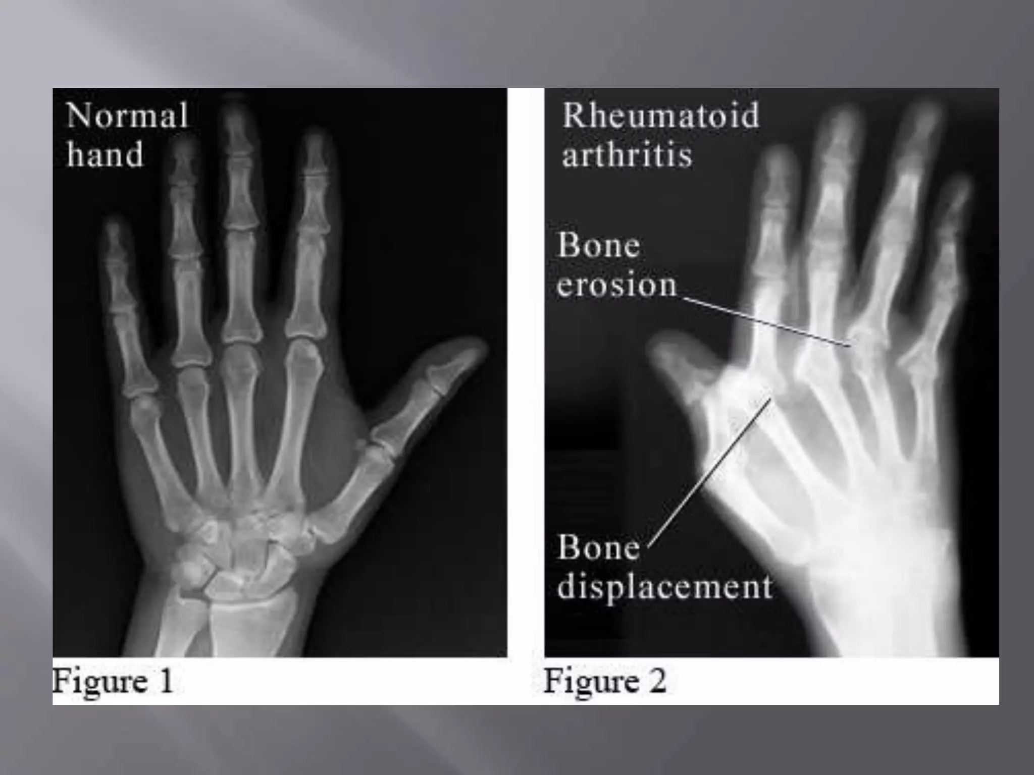 rheumatoid arthritis,gout & osteoarthritis | PPTX