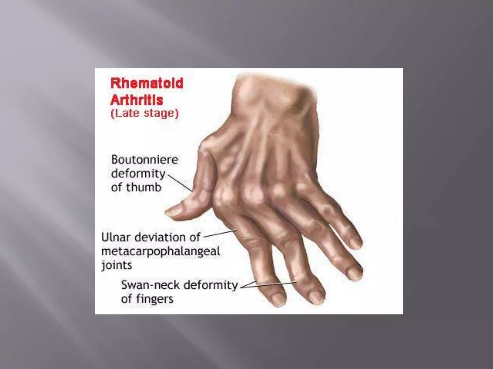 rheumatoid arthritis,gout & osteoarthritis | PPTX