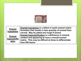 13 the white spot lesion | PPTX