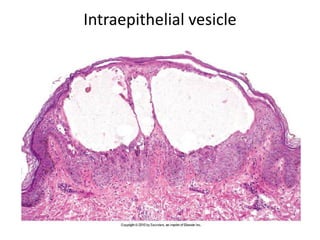 Final oral mucosal lesions | PPT