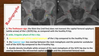 6 Slipped Capital Femoral Epiphysis PDF (2).pdf