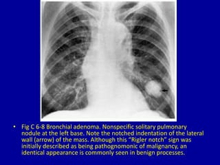 6 solitary pulmonary nodule | PPT