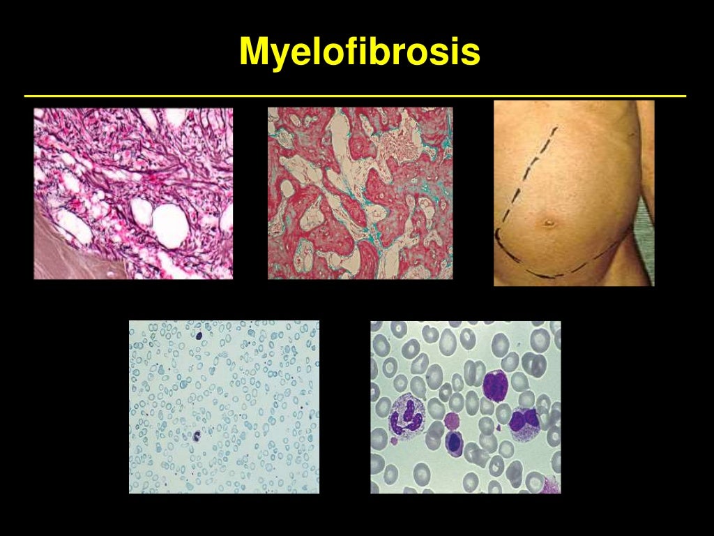 Treatment of High Risk Myelofibrosis.