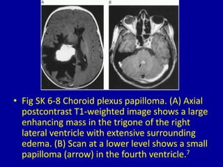 6 supratentorial masses on magnetic resonance imaging | PPTX