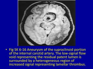 6 supratentorial masses on magnetic resonance imaging | PPT