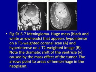 6 supratentorial masses on magnetic resonance imaging | PPTX