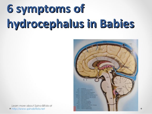Hydrocephalus Baby Signs 6 Symptoms Of Hydrocephalus In Babies